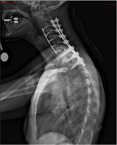 Adult Cervical Deformity - Dr. Justin Smith