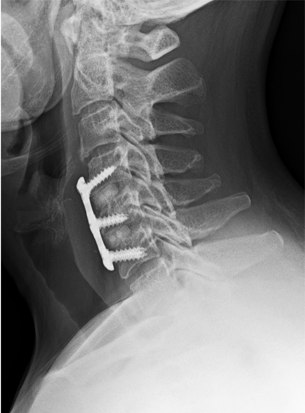 ACDF - Dr. Justin Smith