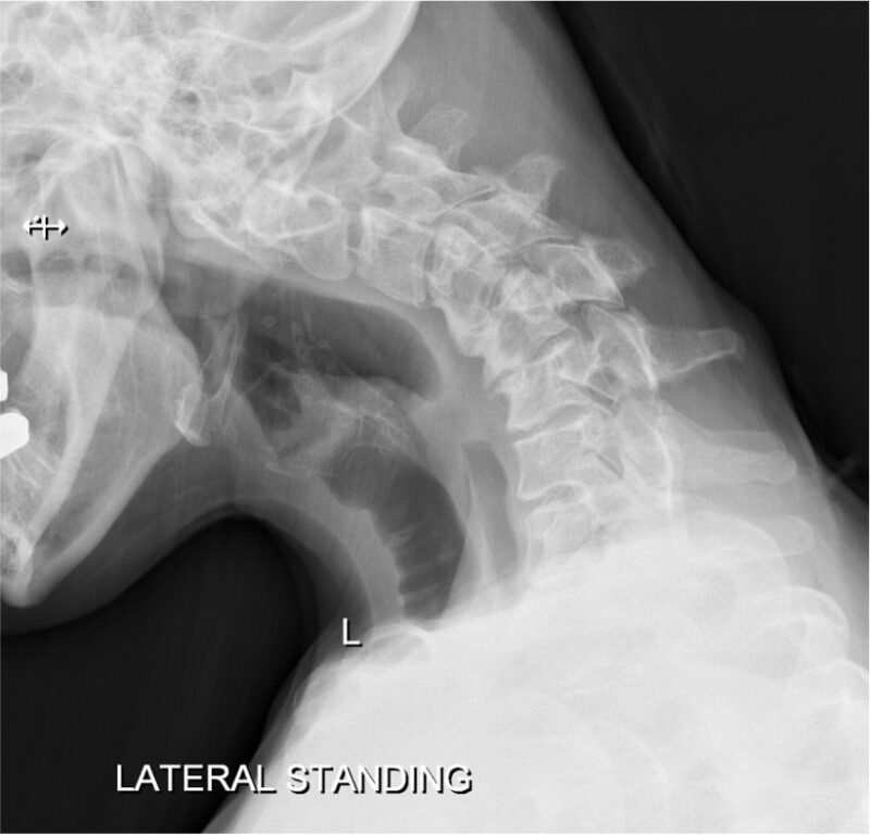 Adult Cervical Deformity - Dr. Justin Smith
