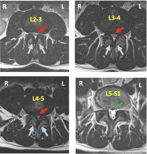 Laminectomy - Dr. Justin Smith
