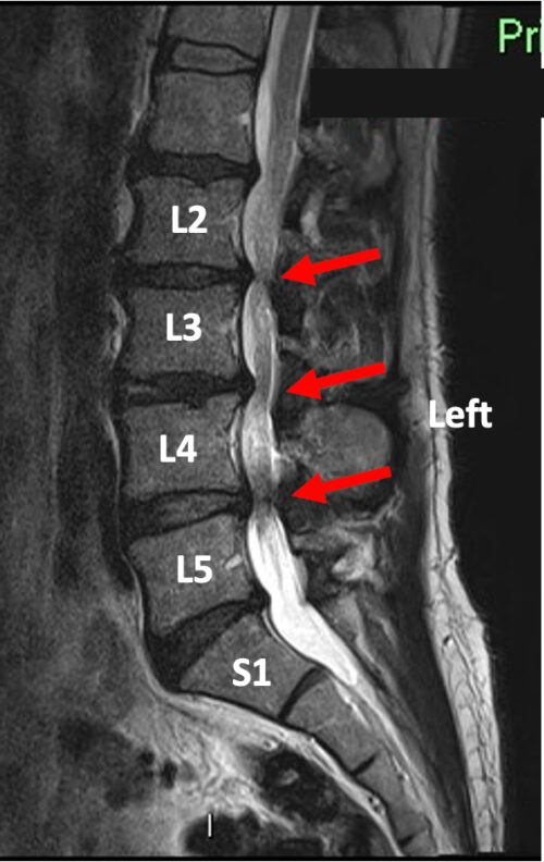 Laminectomy - Dr. Justin Smith