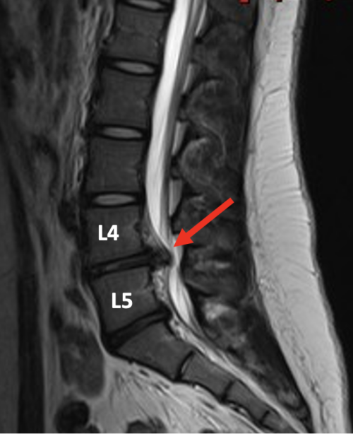 Microdiscectomy Dr Justin Smith