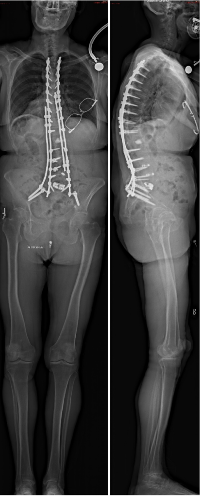 Sagittal Imbalance - Dr. Justin Smith