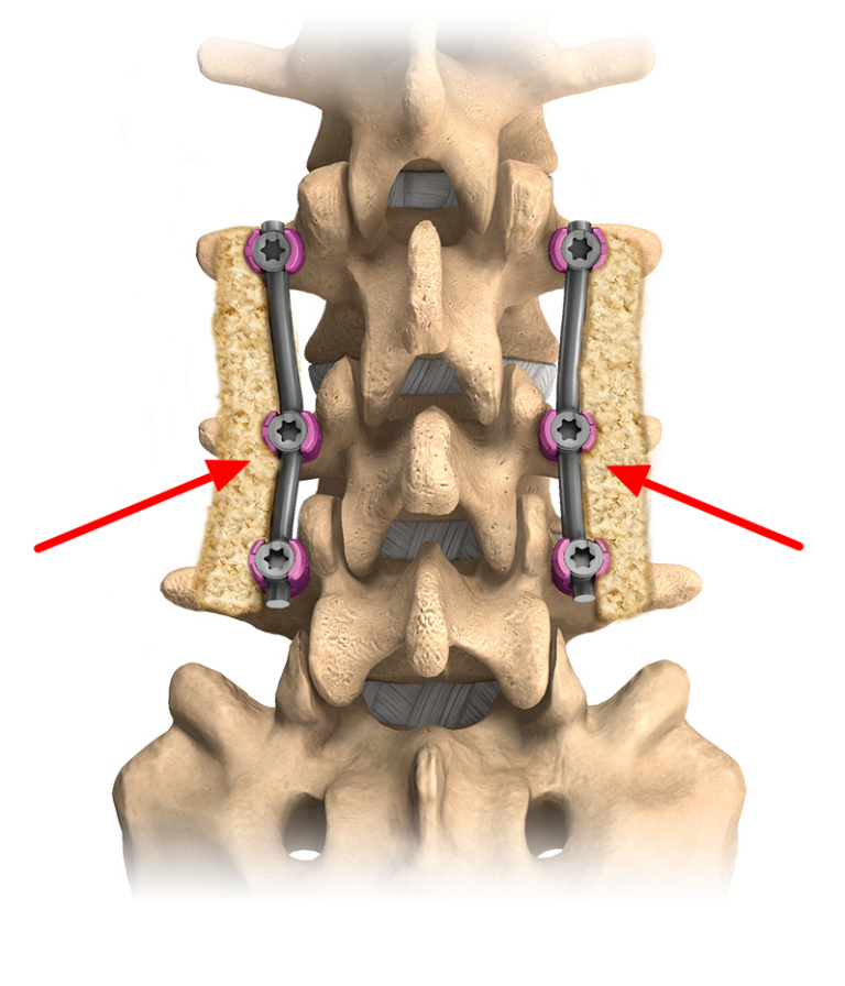 Spinal Fusion - Dr. Justin Smith