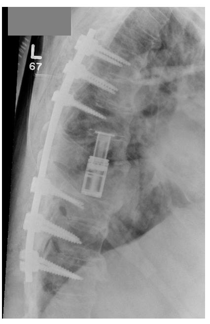 Spine Tumor - Dr. Justin Smith
